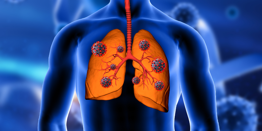 What is Legionnaires Disease? Causes, Treatment, and Safety Tips